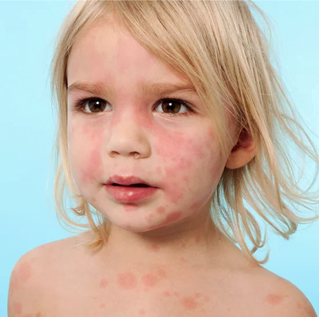Rashes in Children (with Pictures) | Poppet