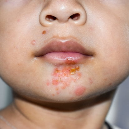 Rashes in Children (with Pictures) | Poppet
